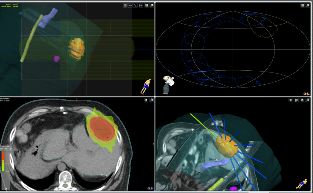 Radiotherapy | ABC Medical Center