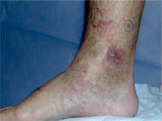 Venous stasis ulcers | ABC Medical Center