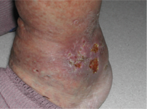 Úlceras por estasis venosa | Centro Médico ABC