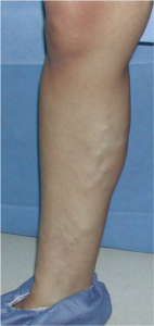 Varicose veins | ABC Medical Center