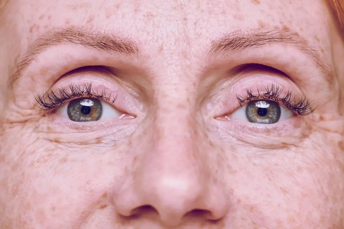 ¿Cómo se desarrolla la amaurosis y esta tiene cura?