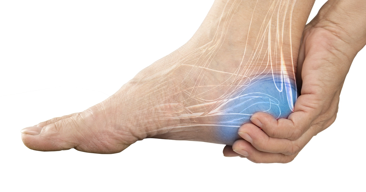 ¿Qué es el espolón calcáneo? | Centro Médico ABC